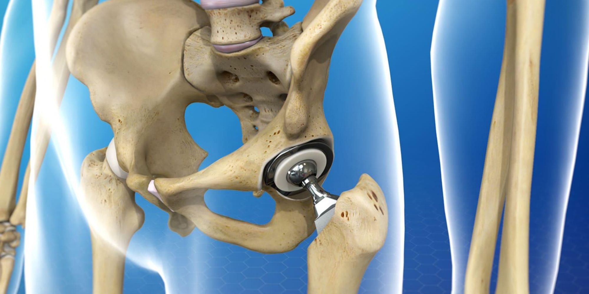Understanding Hip Replacement Surgery