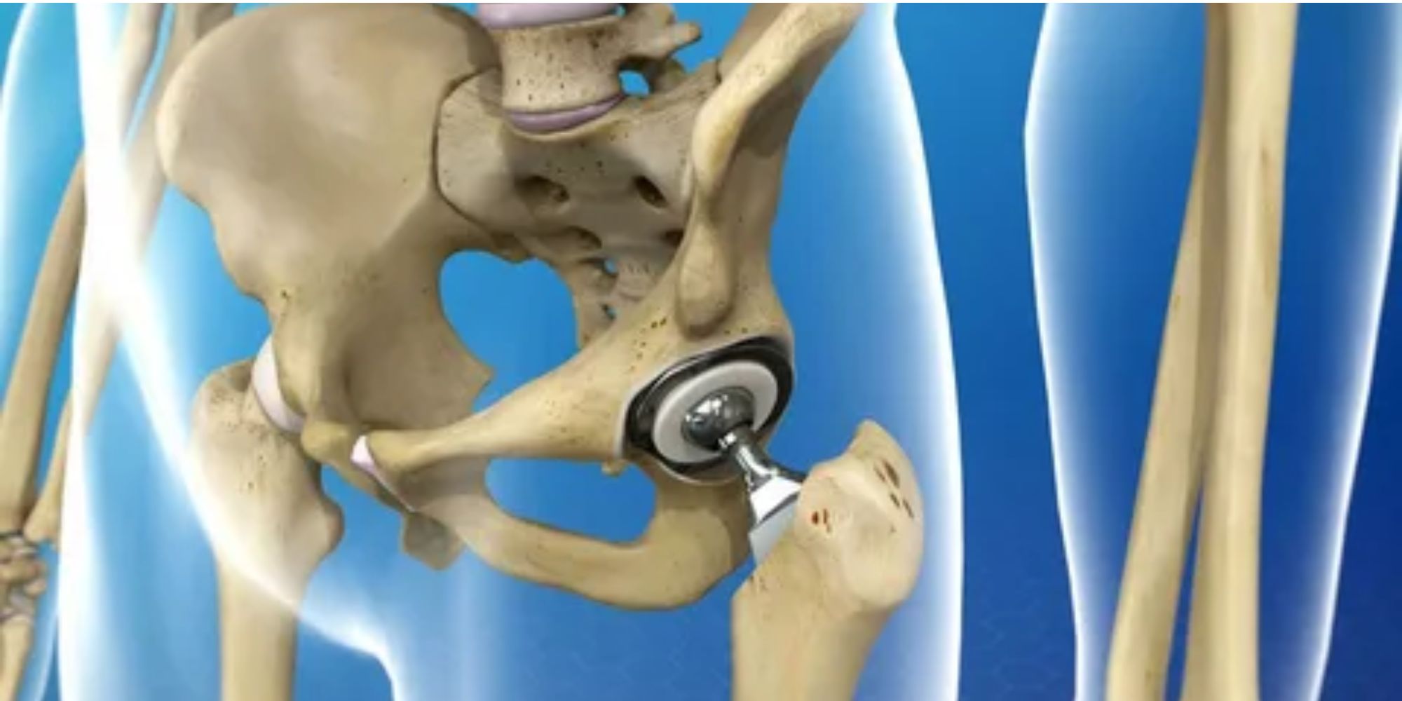 What is Hip Replacement? Understanding the Procedure and Its Benefits ...